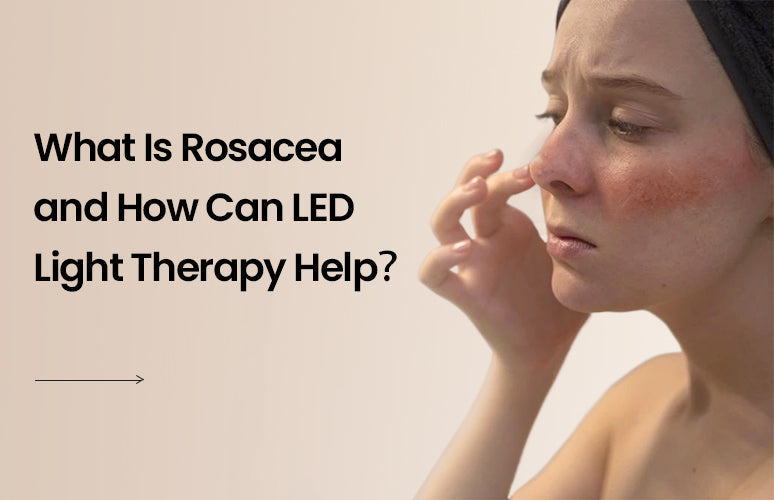 What Is Rosacea and How Can LED Light Therapy Help？